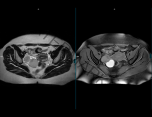 Resonancia Magnética de Pelvis sin Contraste - DMI